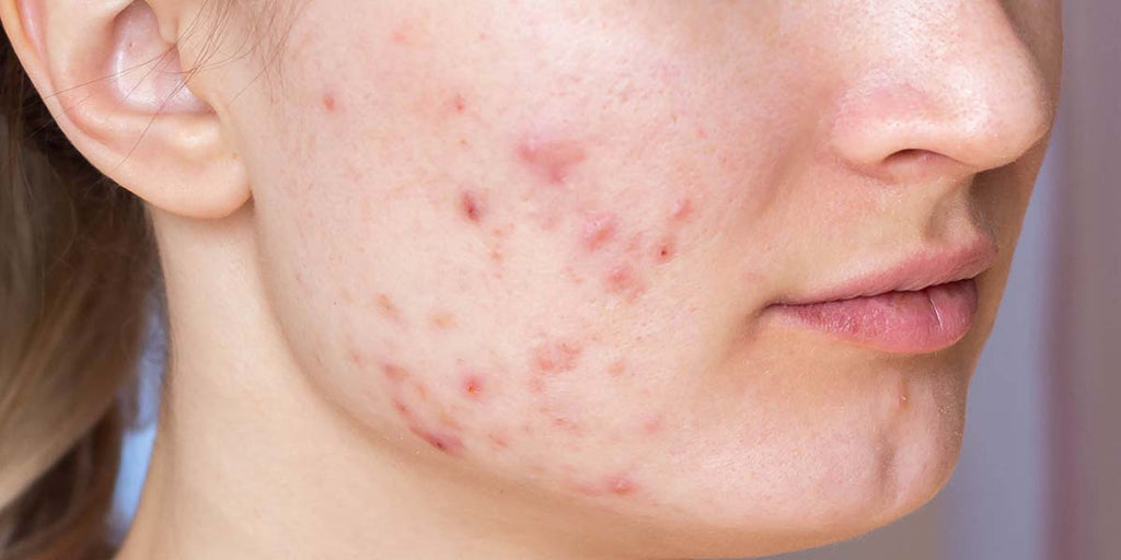 Amy Saunders' Holistic Approach to Clearing Her Acne – AMPERNA®