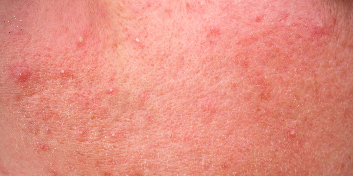 Adult Pimples, Rosacea and What to do About Them – AMPERNA®