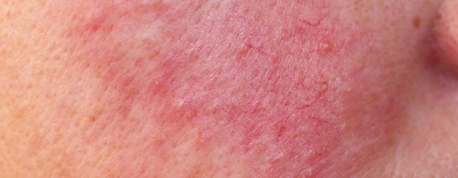 Skin Concerns | Probiotic Skincare For Rosacea, Acne & More – AMPERNA®