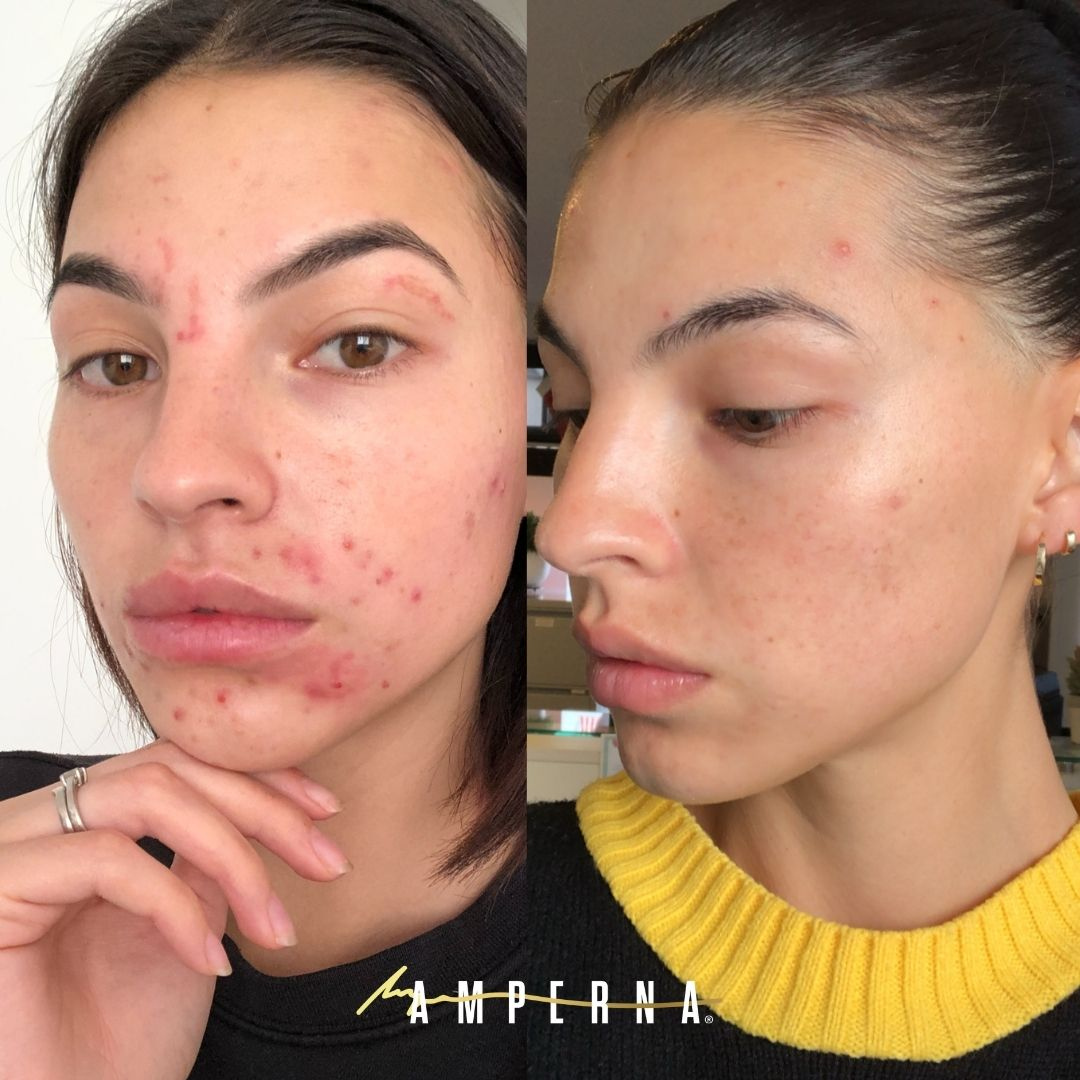 Acne Plus | Topical Probiotics For Acne | AMPERNA®