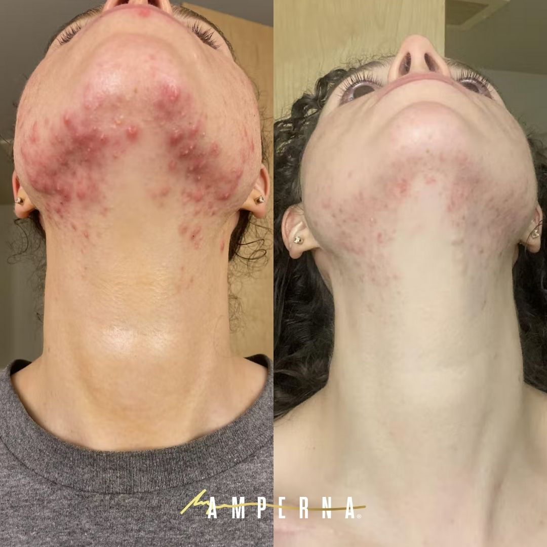 Acne Trio | Probiotics For Acne | AMPERNA®