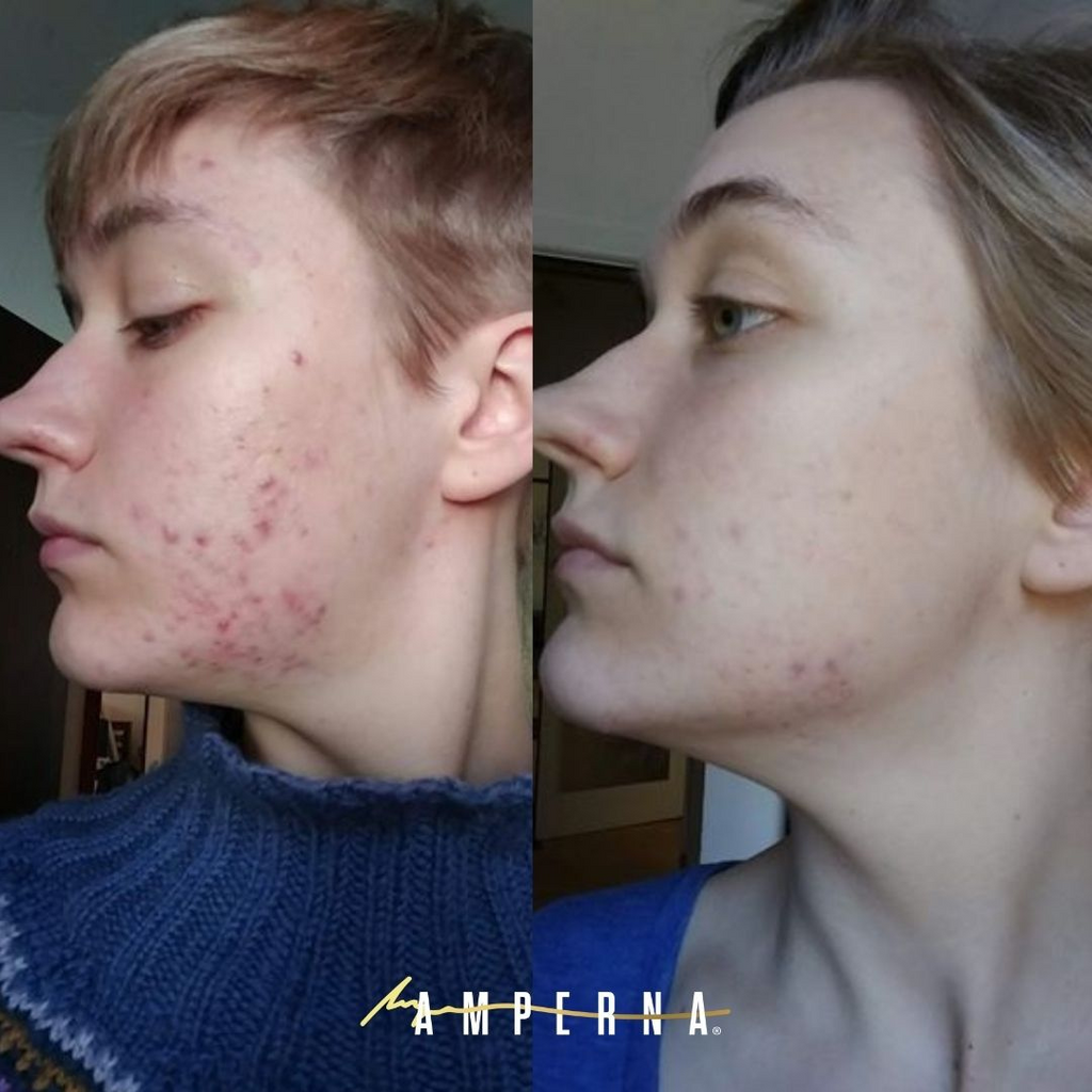 Acne Trio | Probiotics For Acne | AMPERNA®